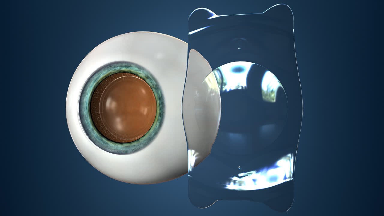 Intraocular Collamer Lens (ICL) | Freedom Eye Laser