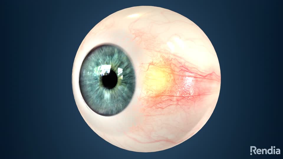 Pinguecula Excision | Freedom Eye Laser