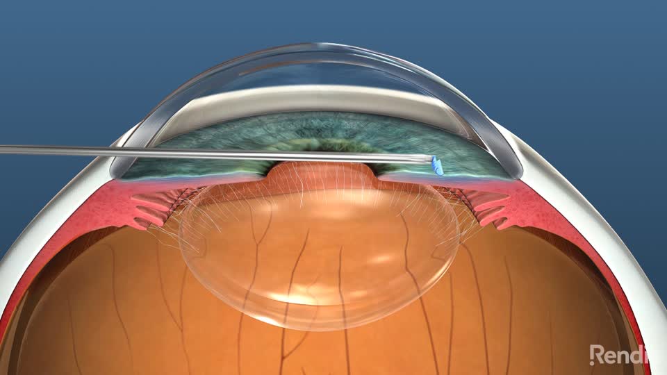 iStent | Freedom Eye Laser