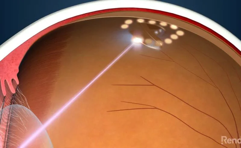 Laser Retinopexy | Freedom Eye Laser — Freedom Eye Laser